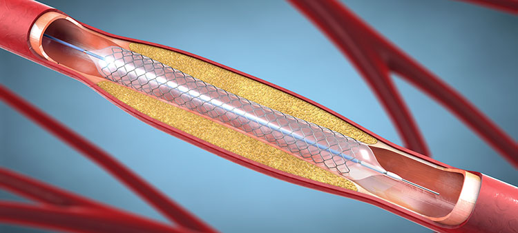 Monitoring Stents Through Skin